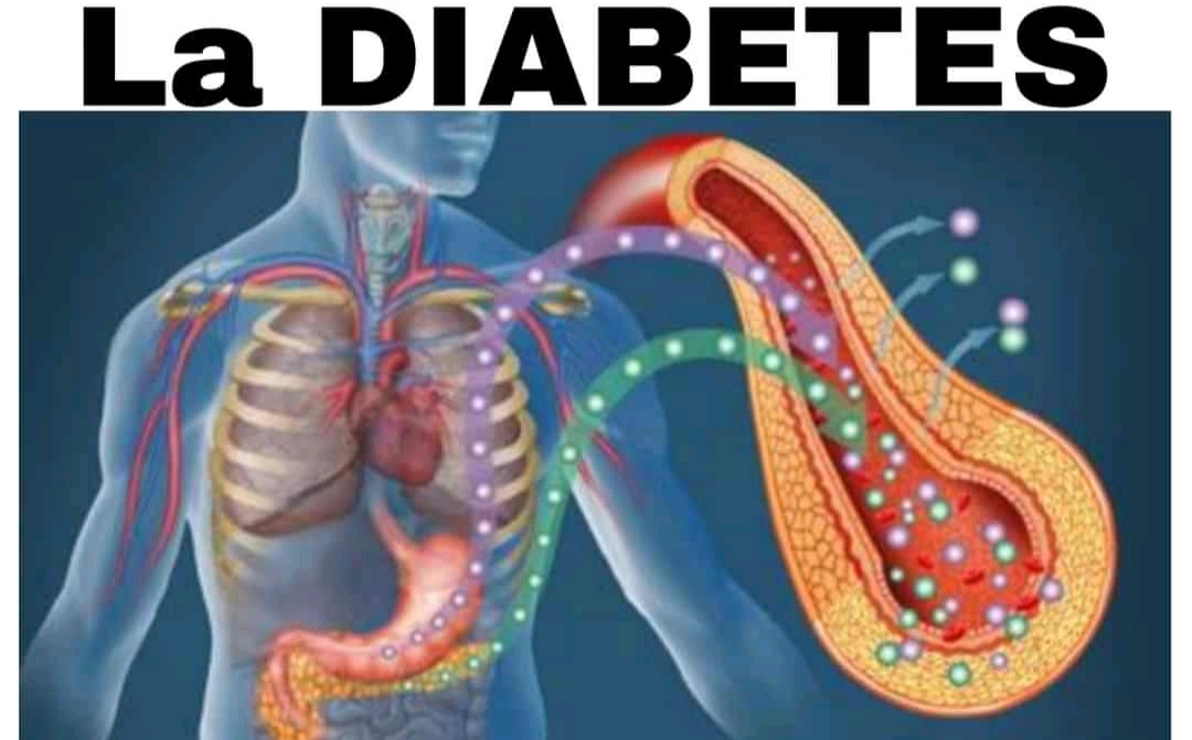 Diabetes: 7 remedios caseros para tratarla de manera natural ...